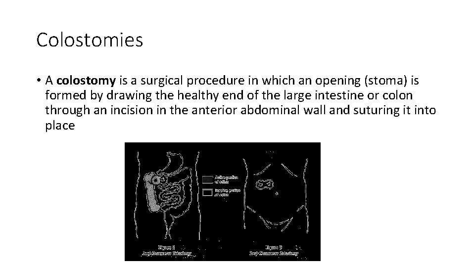 Colostomies A colostomy is a surgical procedure in