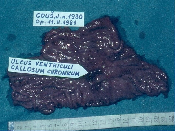 Gastric and duodenal ulcer disease Ulcer disease n