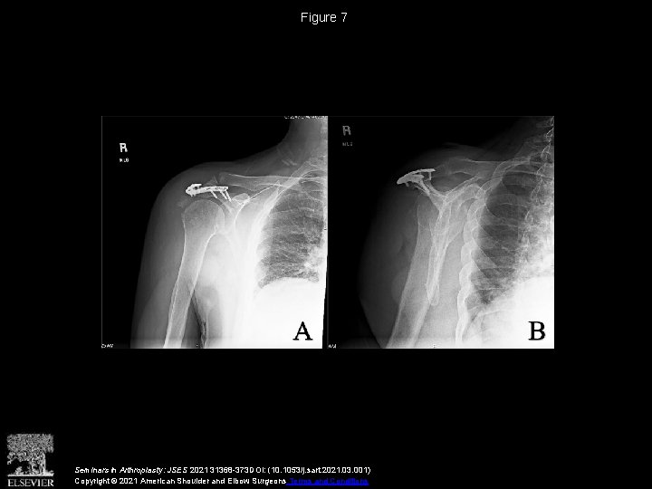 Acromial osteotomy complications of lower trapezius transfer for