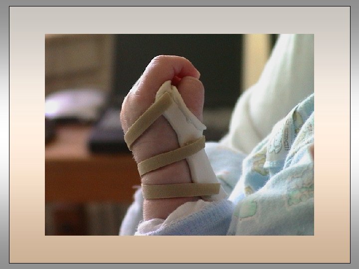 Splint Photo Album 28 a Dynamic handbased PIP