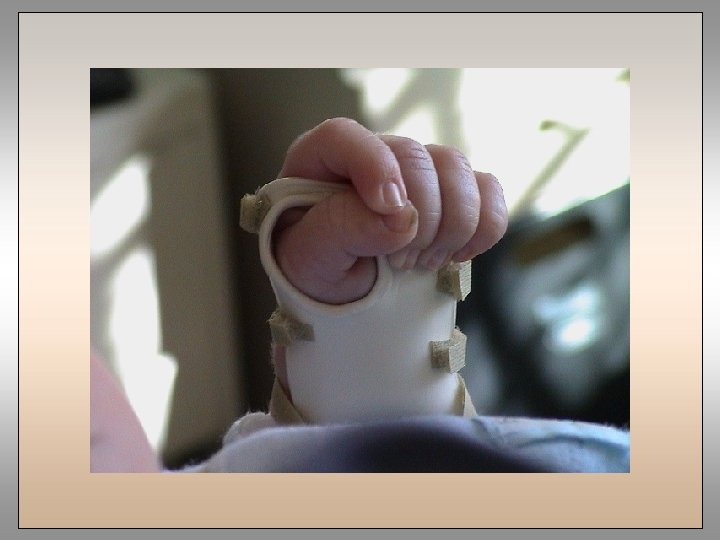 Splint Photo Album 28 a Dynamic handbased PIP