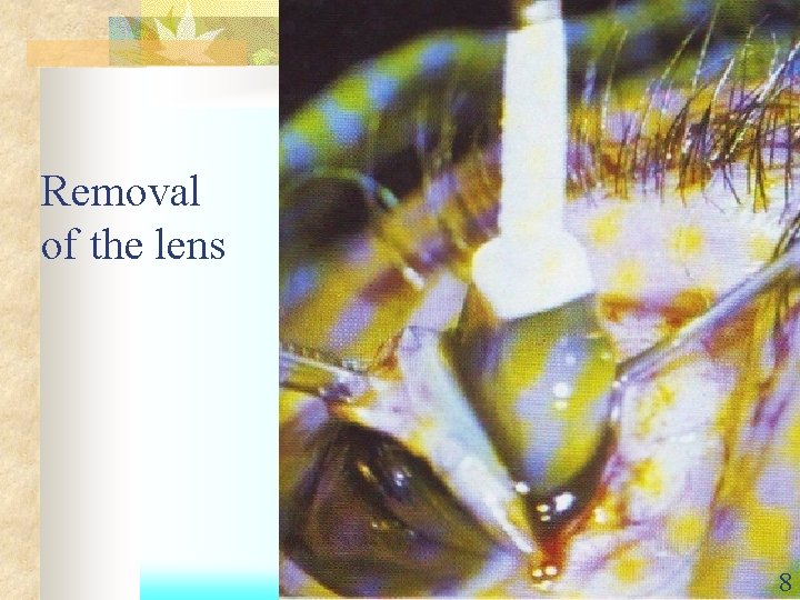 PENJAGAAN SEBELUM DAN SELEPAS PEMBEDAHAN MATA KATARAK 1