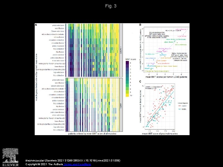 Miyoshi myopathy and limb girdle muscular dystrophy R