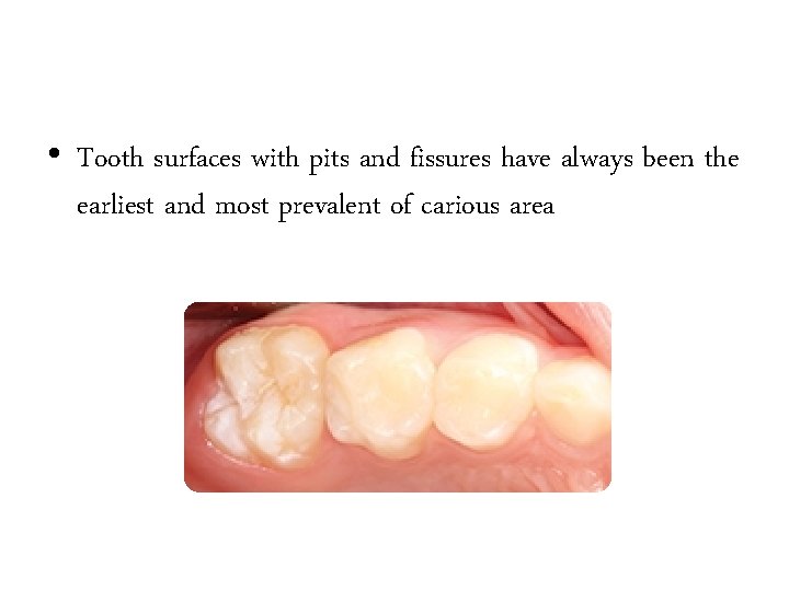 Tooth surfaces with pits and fissures have always