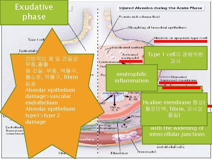 Acute respiratory distress syndrome About ARDS Case STUDY