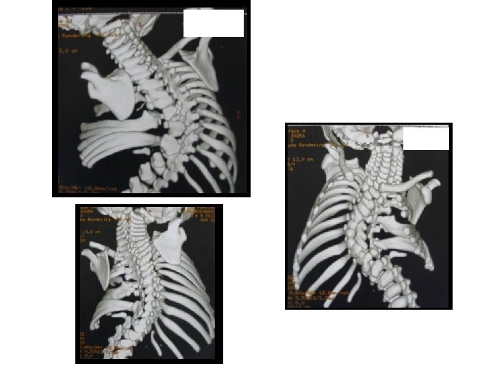 Indications du VEPTR dans les malformations costovertebrales Philippe