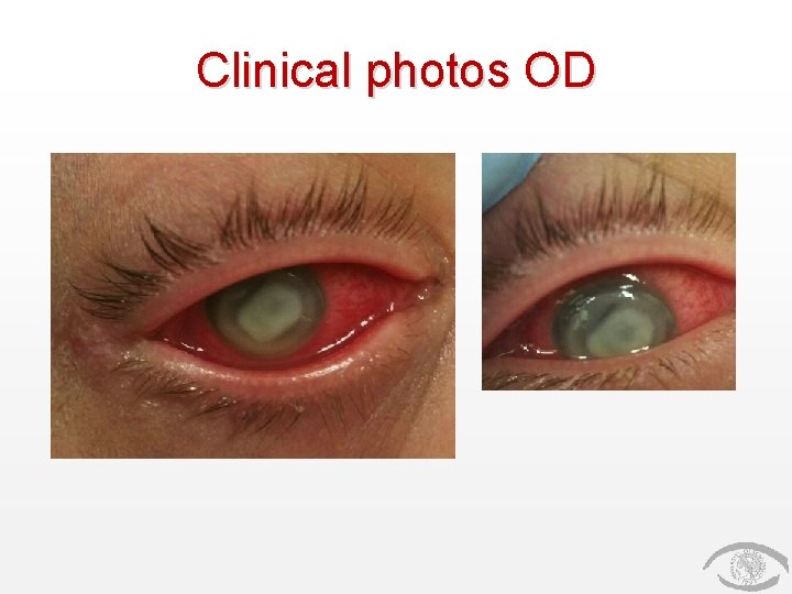 Corneal Ulcers in Methamphetamine Use Lara Rosenwasser Newman