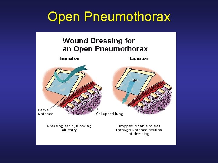 Treating Penetrating Chest Trauma Introduction The body has