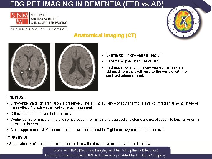 Brain Tech TIME Case Study FDG PET IMAGING