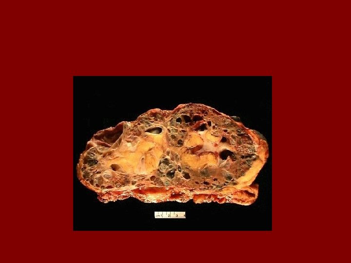 INHERITED RENAL DISORDERS AUTOSOMAL DOMINANT POLYCYSTIC KIDNEY DISEASE