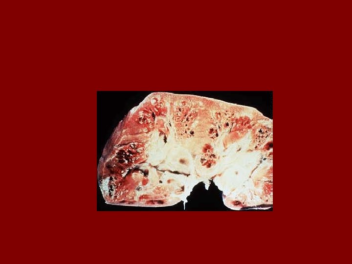 INHERITED RENAL DISORDERS AUTOSOMAL DOMINANT POLYCYSTIC KIDNEY DISEASE