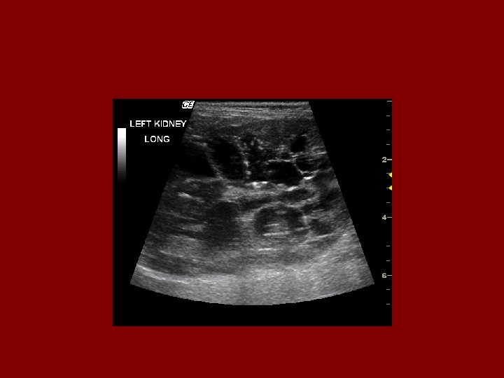INHERITED RENAL DISORDERS AUTOSOMAL DOMINANT POLYCYSTIC KIDNEY DISEASE