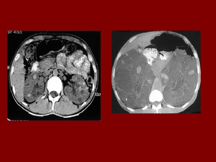INHERITED RENAL DISORDERS AUTOSOMAL DOMINANT POLYCYSTIC KIDNEY DISEASE