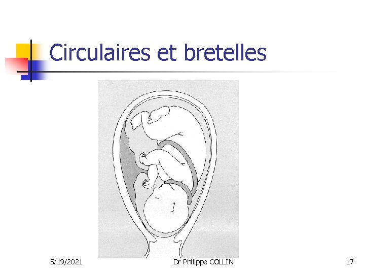 Physiologie et pathologie du cordon ombilical n Plan