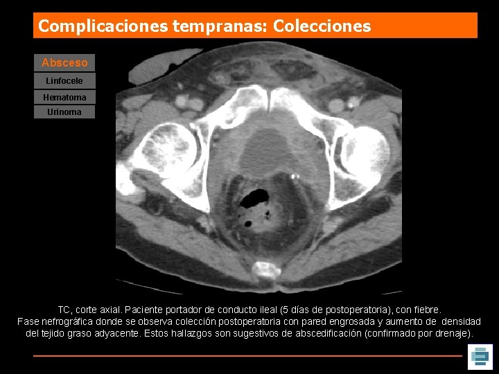 Derivacin urinaria Complicaciones tempranas Absceso Colecciones ...