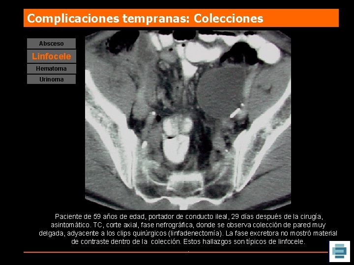 Derivacin urinaria Complicaciones tempranas Absceso Colecciones ...