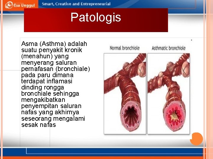 Asthma Bronchiale Eko Wibowo S Ft M Fis