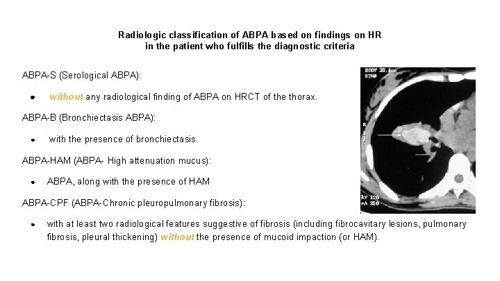 ABPA Babak Ghalibaf MD Aspergillus related disease Aspergillus