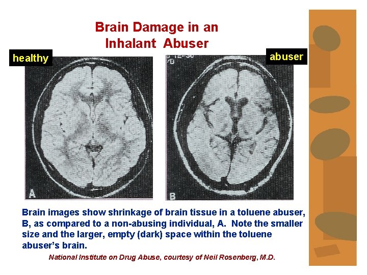 What Every Student Needs To Know About Inhalant