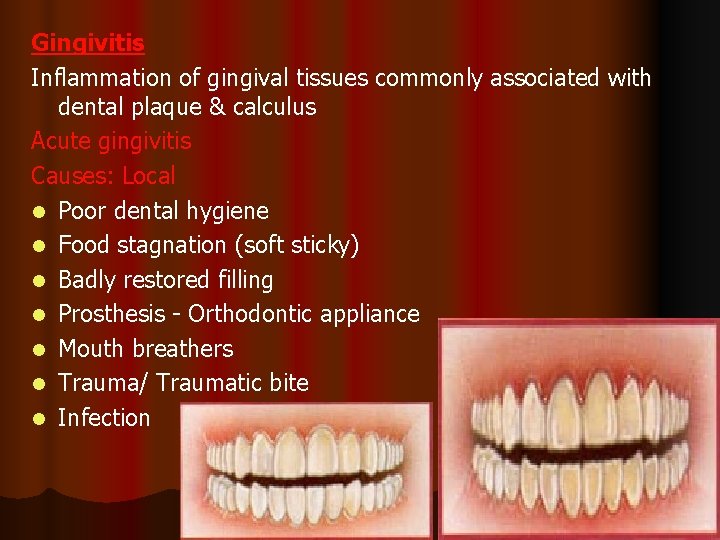 Gingivitis Inflammation of gingival tissues commonly associated with
