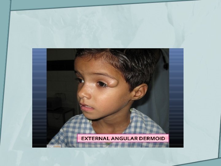 Types of dermoid cyst 1 Sequestration dermoid cyst