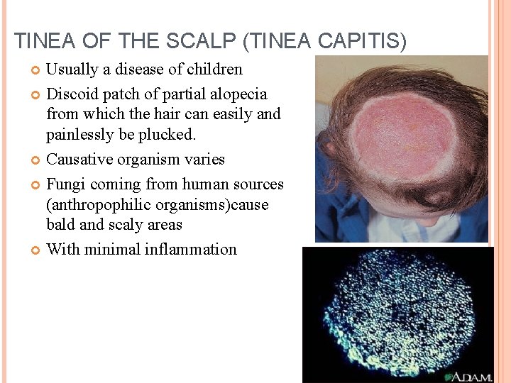 Fungal infections Dermatophytic infections ringworm CAUSE Three genera