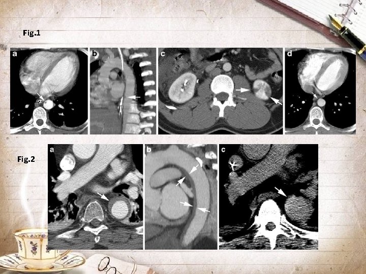 Minimal aortic injury of the thoracic aorta imaging