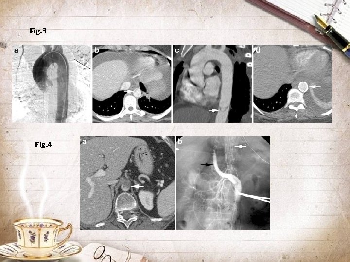 Minimal aortic injury of the thoracic aorta imaging