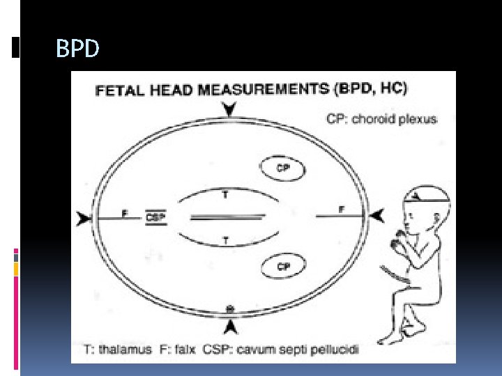 Lecture 7 Ultrasound evaluation of Fetal Biometry and