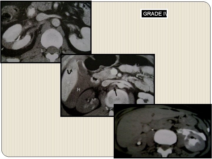 UR 13 CT FINDINGS IN BLUNT RENAL TRAUMA