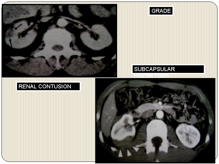 UR 13 CT FINDINGS IN BLUNT RENAL TRAUMA