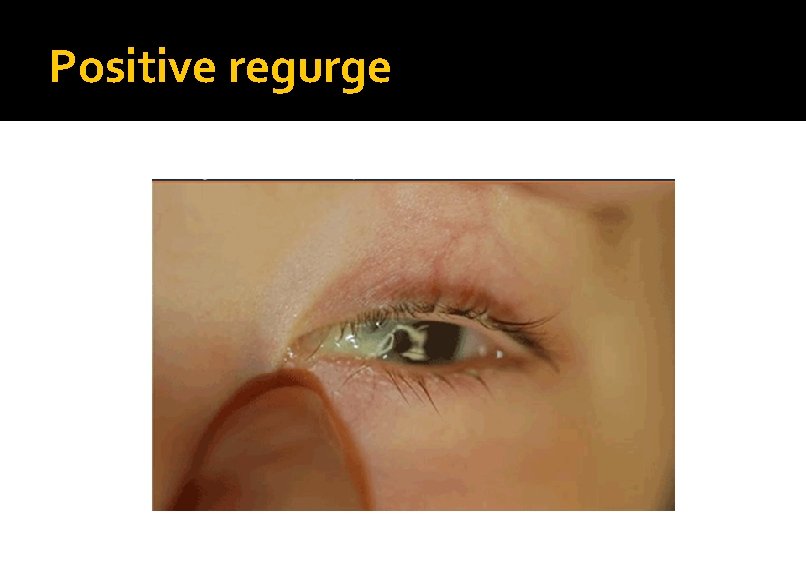 DISEASES OF THE LACRIMAL SYSTEM Dr Ayesha S