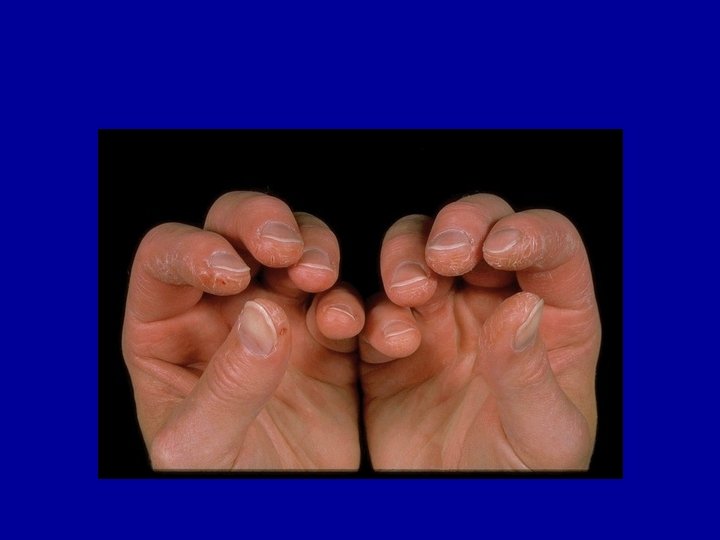 Polimiosite e dermatomiosite Definizione ed eziologia una condizione