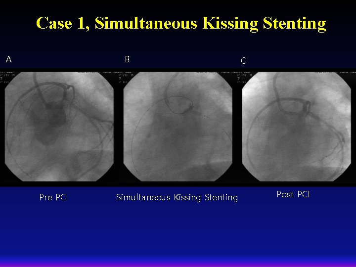 Impact of Bifurcation Stenting Technique on 2 Years