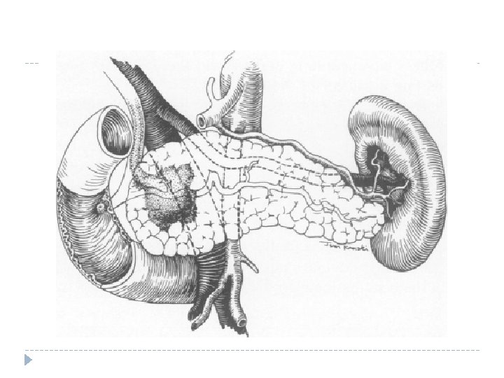 TOTAL PANCREATECTOMY FOR THE TREATMENT OF PANCREATIC NEOPLASM