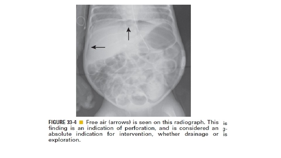 NECROTIZING ENTEROCOLITIS NEC Disease of premature low birth