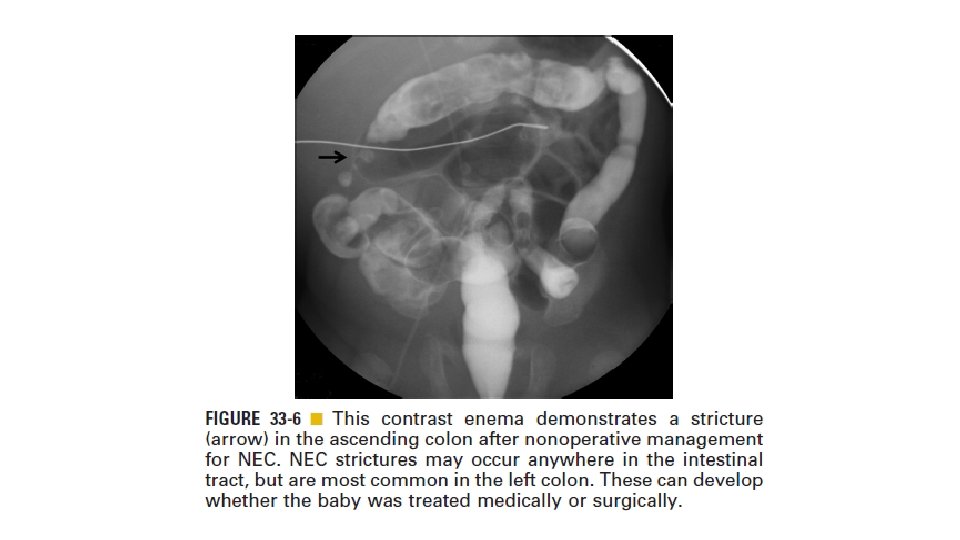 NECROTIZING ENTEROCOLITIS NEC Disease of premature low birth