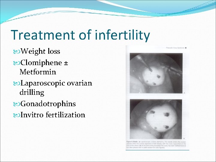 Polycystic ovarian syndrome Described by Stein Leventhal 1935