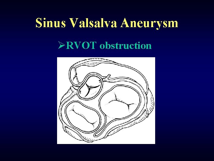 Sinus Valsalva Aneurysm Seoul National University Hospital Department