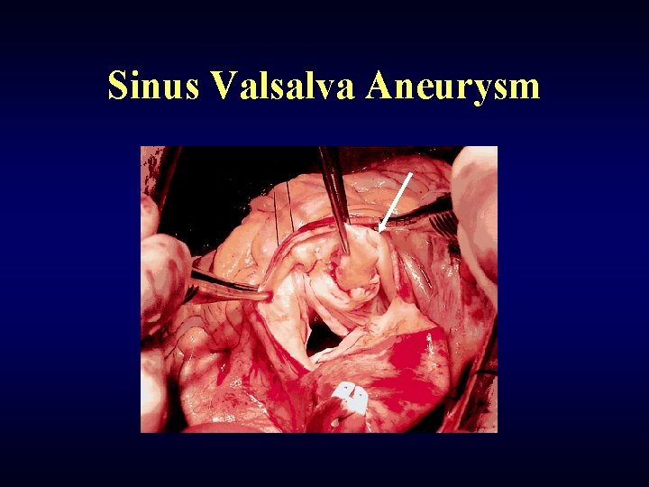 Sinus Valsalva Aneurysm Seoul National University Hospital Department