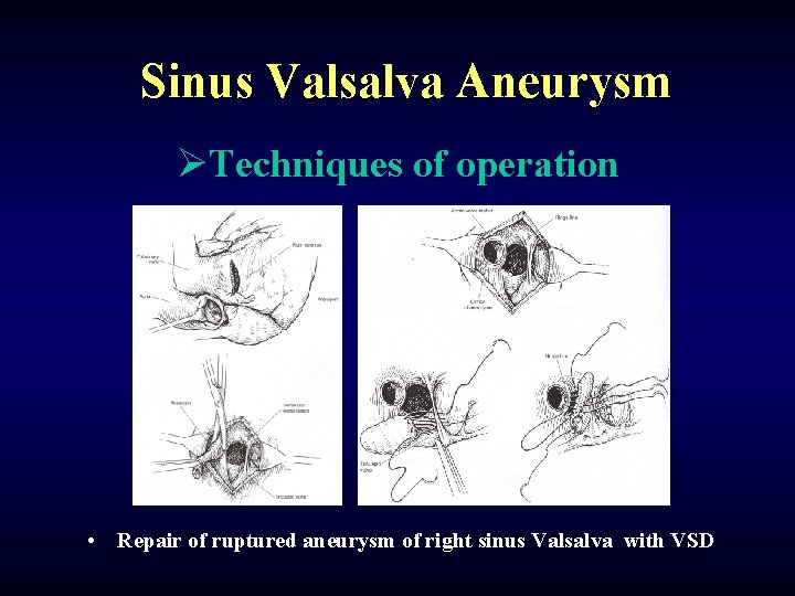 Sinus Valsalva Aneurysm Seoul National University Hospital Department