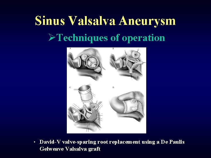 Sinus Valsalva Aneurysm Seoul National University Hospital Department