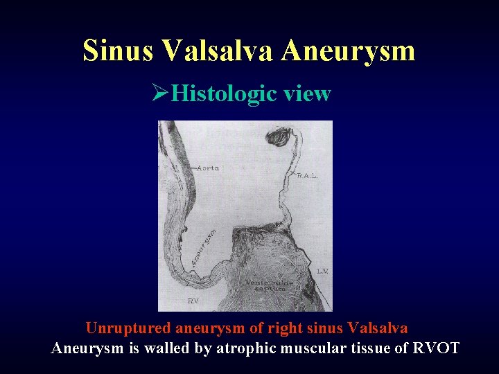 Sinus Valsalva Aneurysm Seoul National University Hospital Department