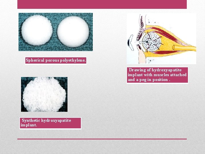 Orbital Implants Prior to 1885 orbital implants were