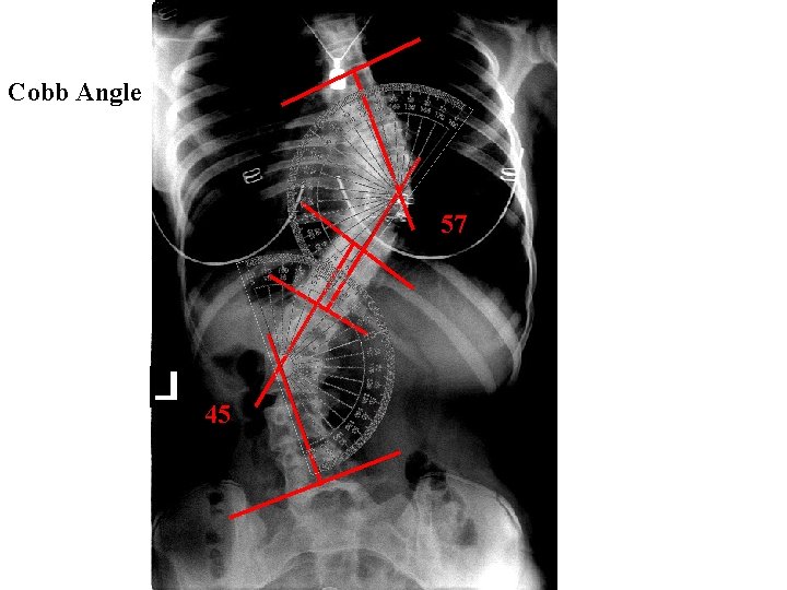 What Every Chiropractor Needs to Know about Scoliosis