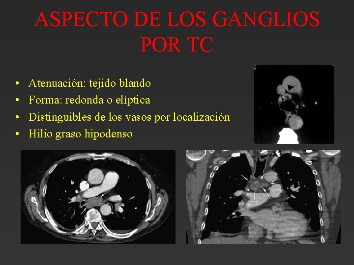 ASPECTO DE LOS GANGLIOS POR TC Atenuacin tejido