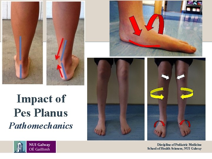 Pes Planus in Down Syndrome Problem Pathology or