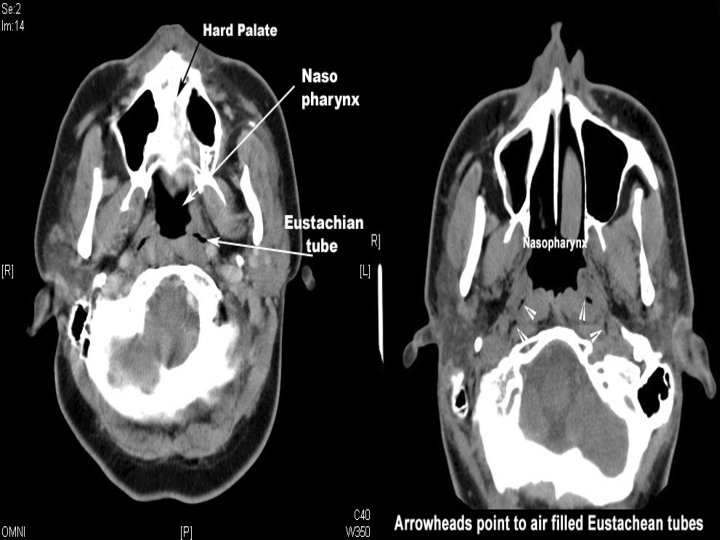 Pharynx Anatomy and conditions The pharynx is a