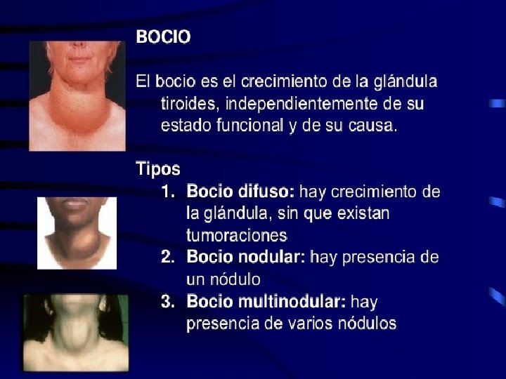 FISIOPATOLOGIA DE TIROIDES 1 BOCIO TODO AUMENTO DE