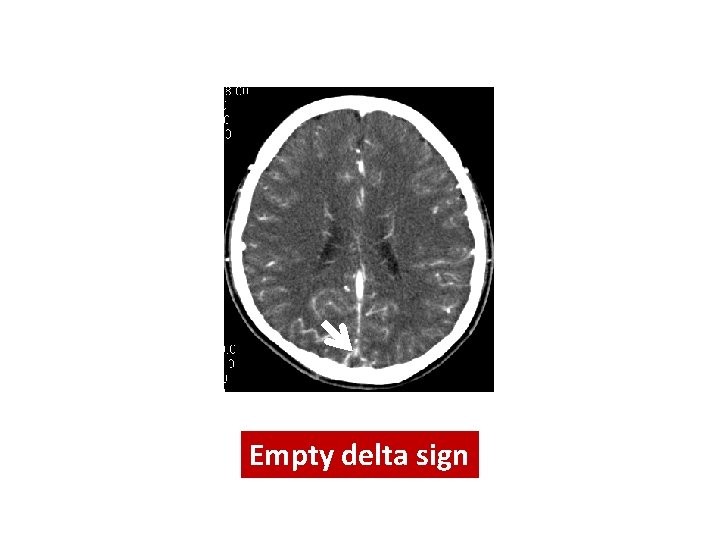 Causes of and Predisposing Factors for Cerebral Venous